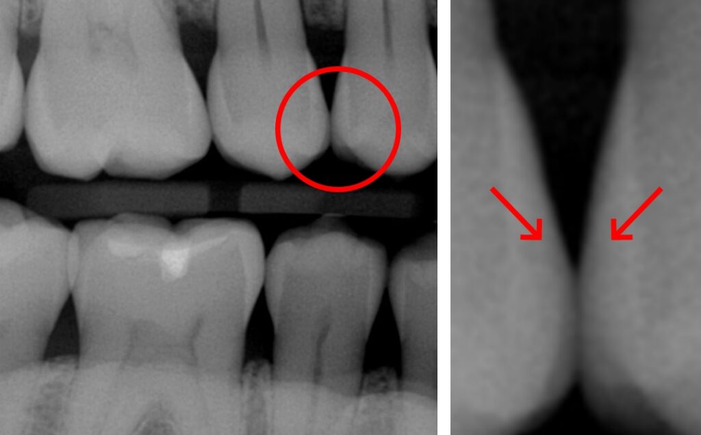 Interproximal initial carious lesions treated with CRFP and Curodont ...